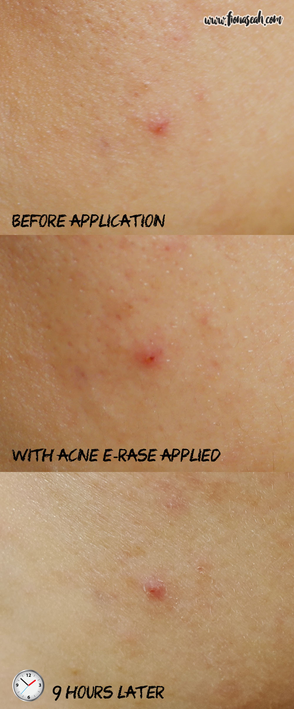 Therapeutic Dermatologic Formula #2: How to Treat Oily Skin & Acne ...